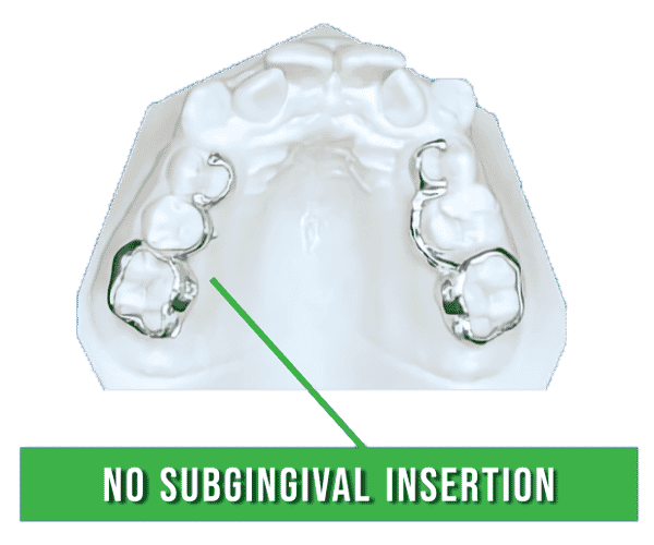 Switch To EOL's 3d Printed Metal Bands! | European Orthodontic ...